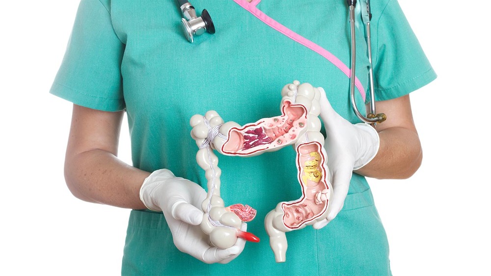 Mit lehet tudni a végbélrákról? | Benyovszky Orvosi Központ