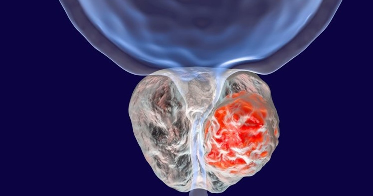 A prosztatadaganat | Benyovszky Orvosi Központ